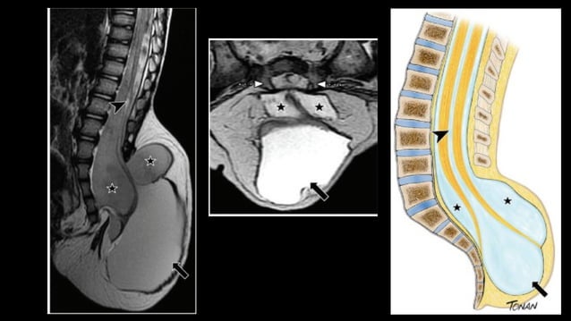 Radiological Imaging In Cases Of Spinal Dysraphism Ppt