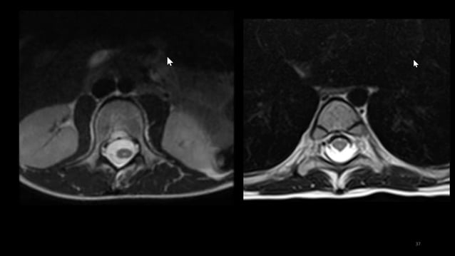 RADIOLOGICAL IMAGING IN CASES OF SPINAL DYSRAPHISM | PPT