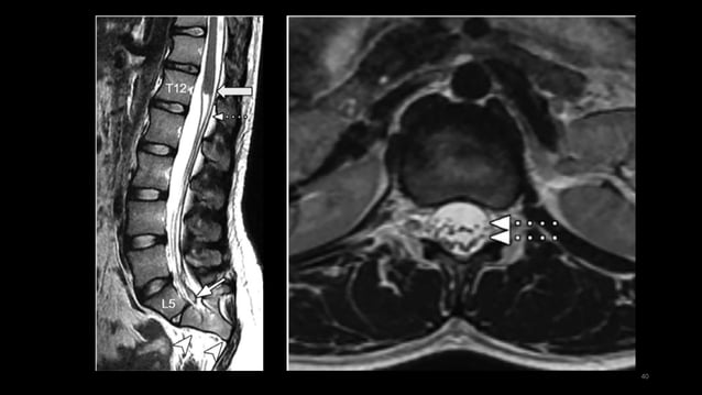 RADIOLOGICAL IMAGING IN CASES OF SPINAL DYSRAPHISM | PPT