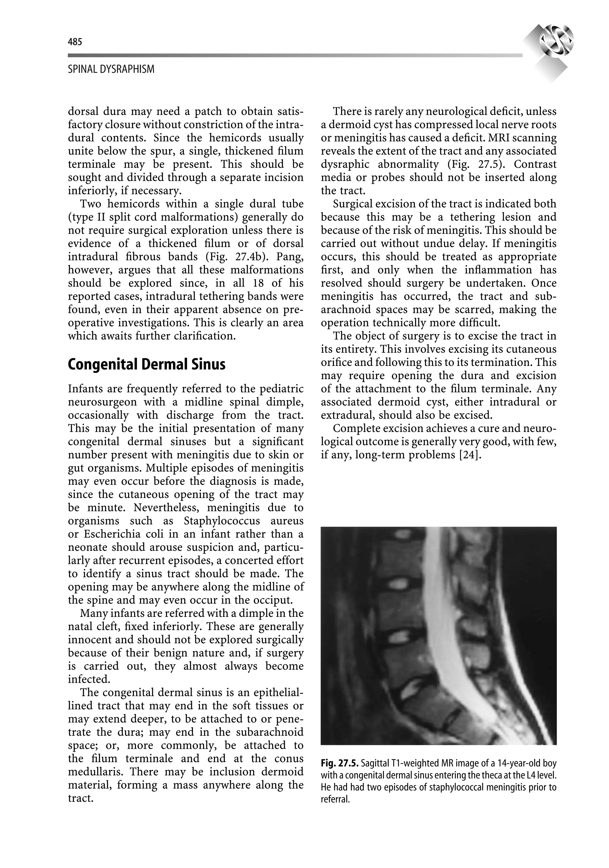 Spinal Dysraphism[1] | PDF