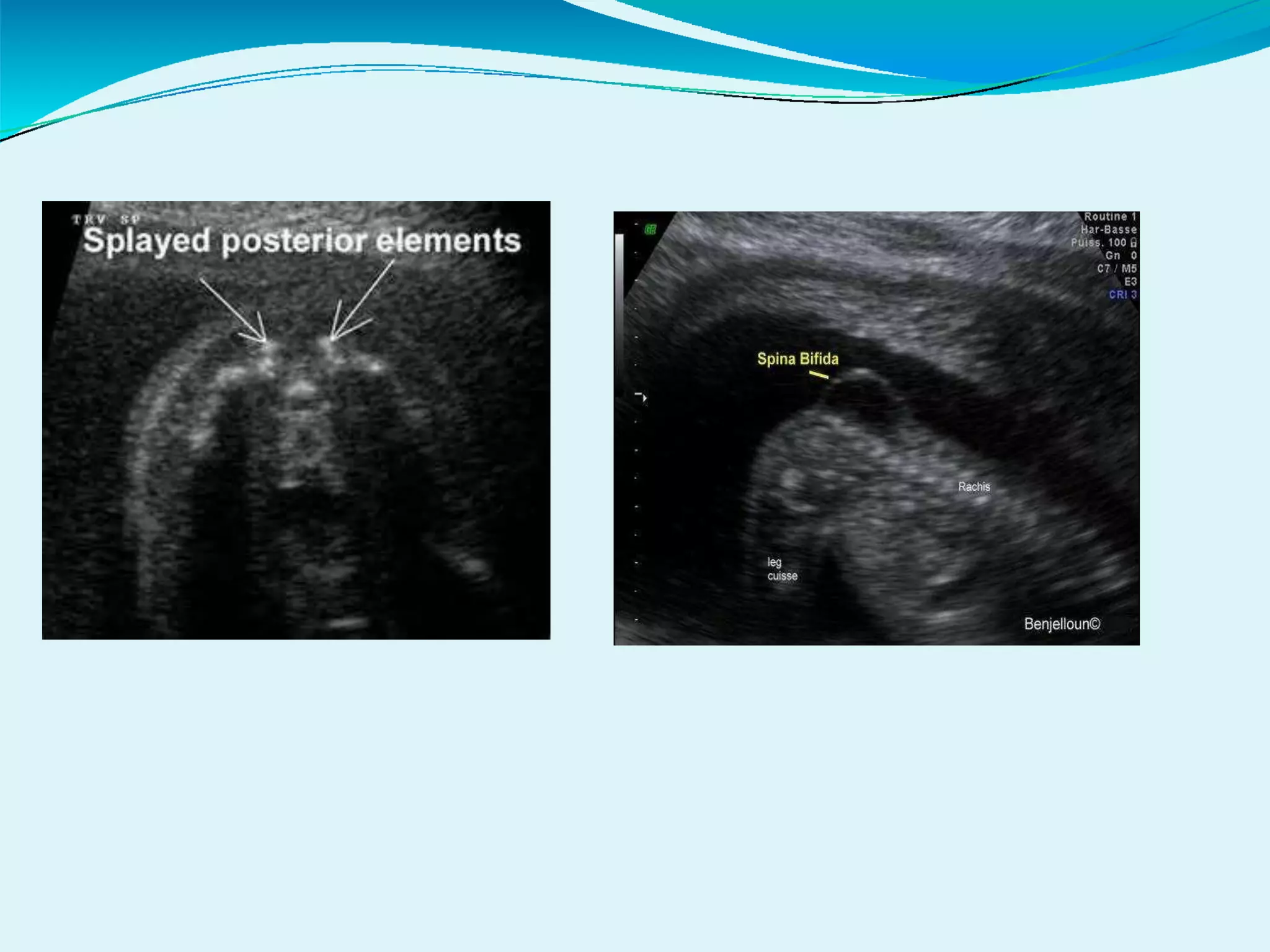 Spinal Dysraphism Adnan Al Banna Pdf