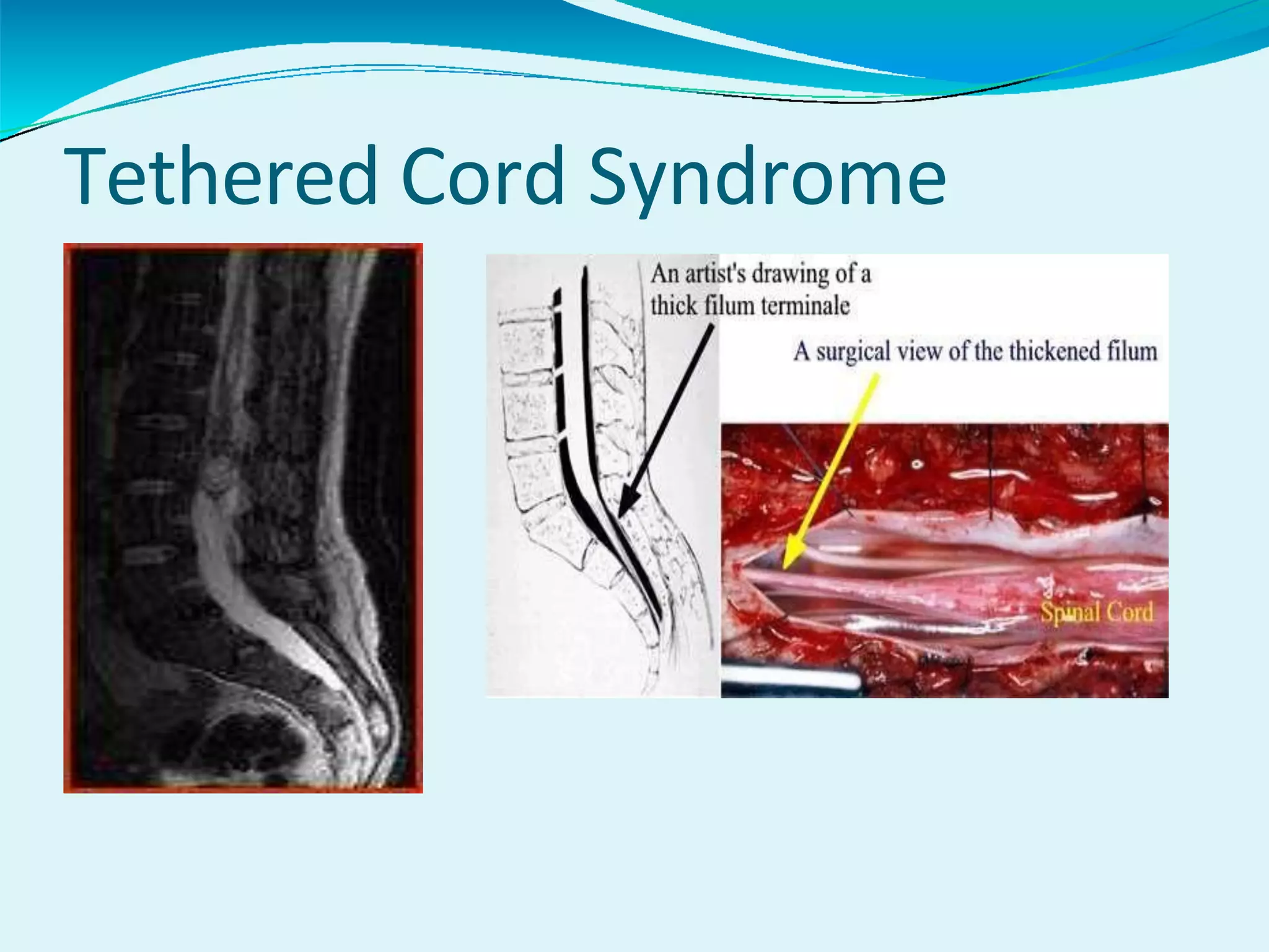 Spinal dysraphism adnan al banna | PDF