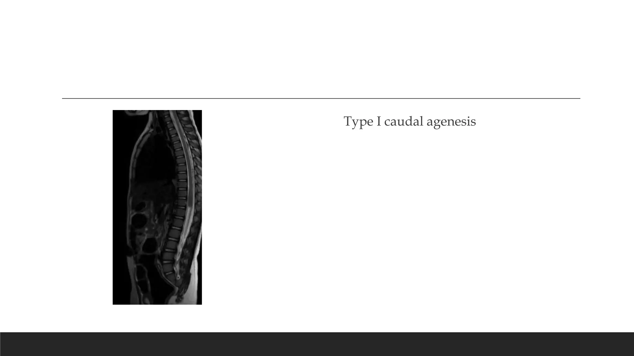 Spinal Dysraphism Vp Pptx
