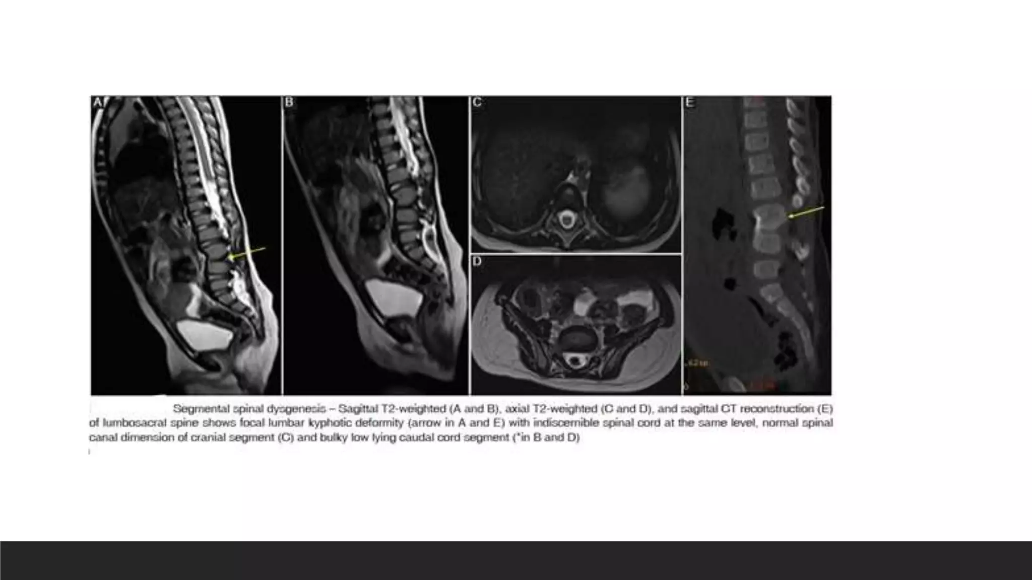 SPINAL dysraphism VP,,.pptx