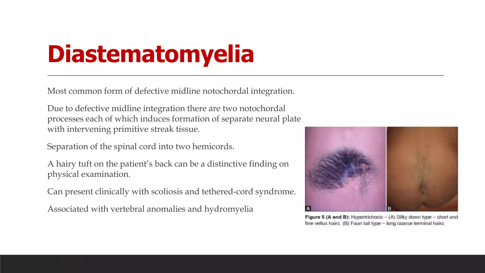 SPINAL dysraphism VP,,.pptx