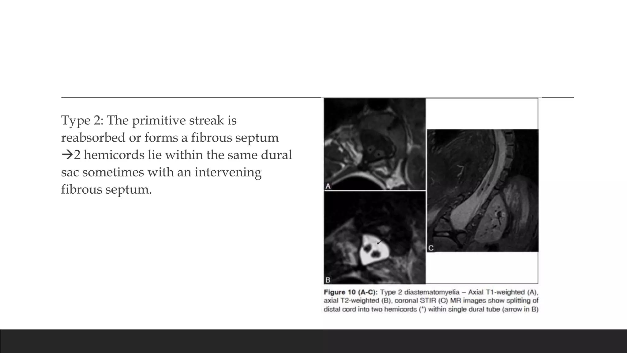 SPINAL dysraphism VP,,.pptx