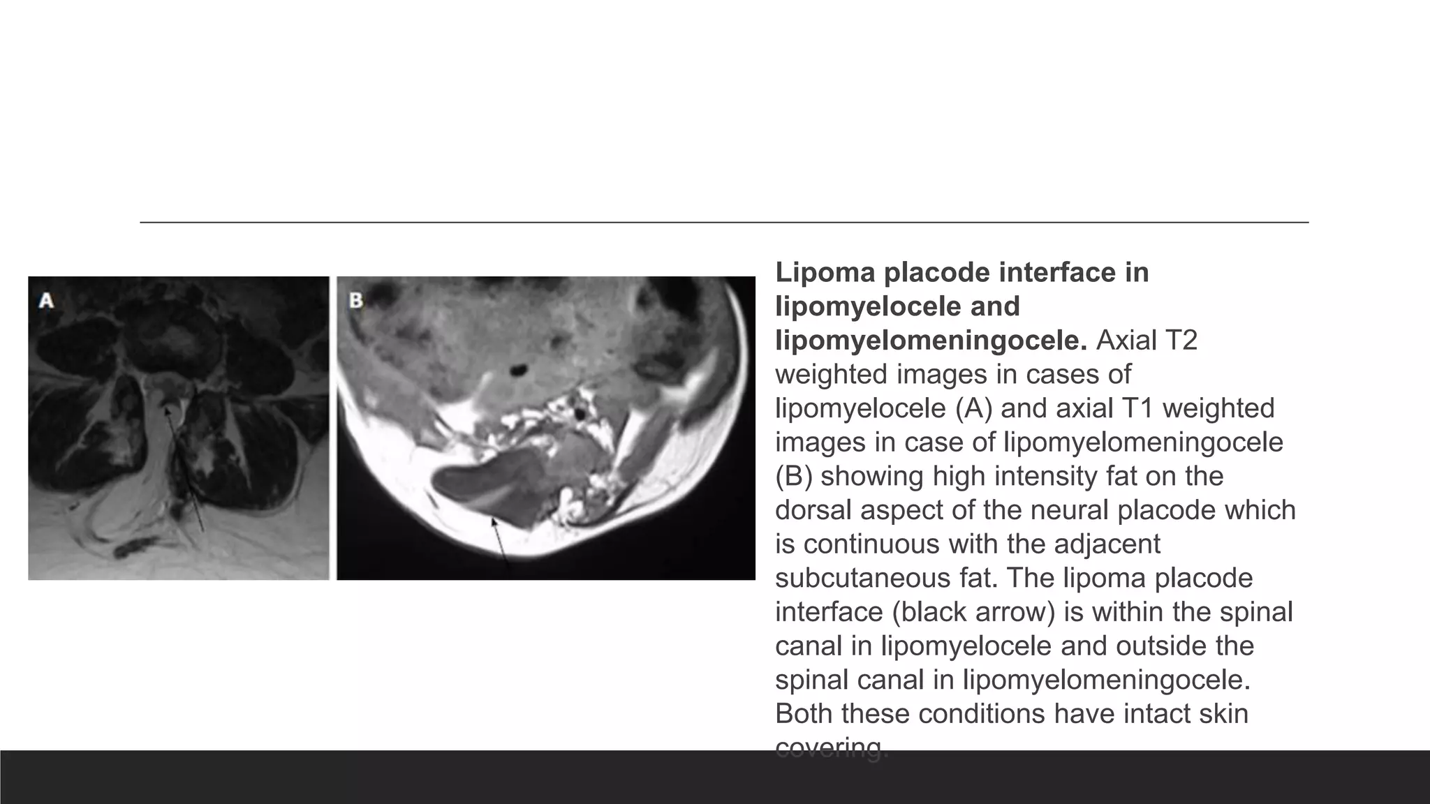 SPINAL dysraphism VP,,.pptx