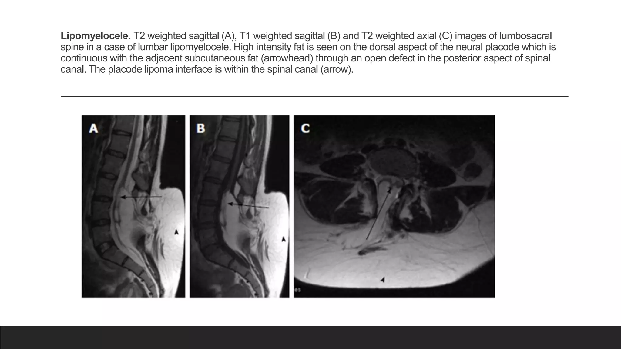 SPINAL dysraphism VP,,.pptx