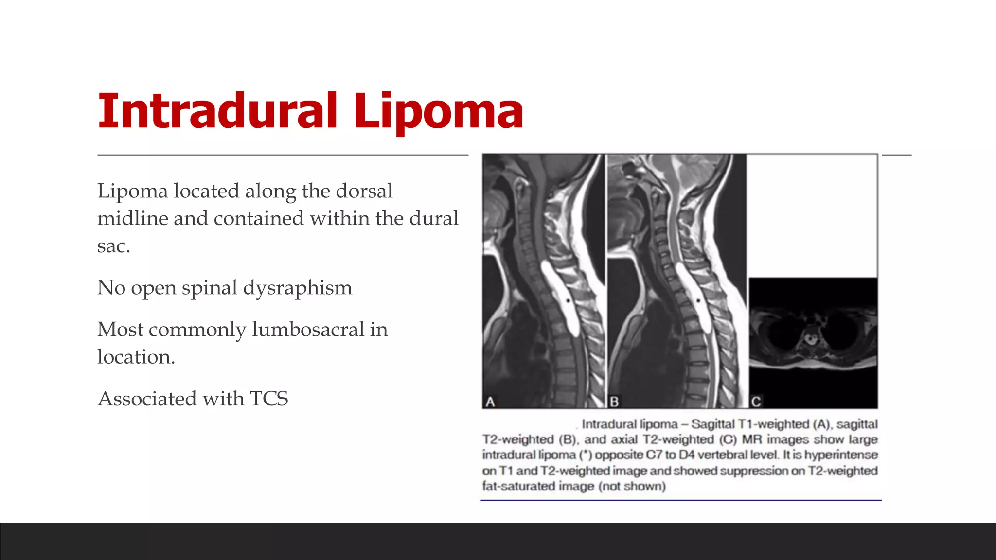 SPINAL dysraphism VP,,.pptx