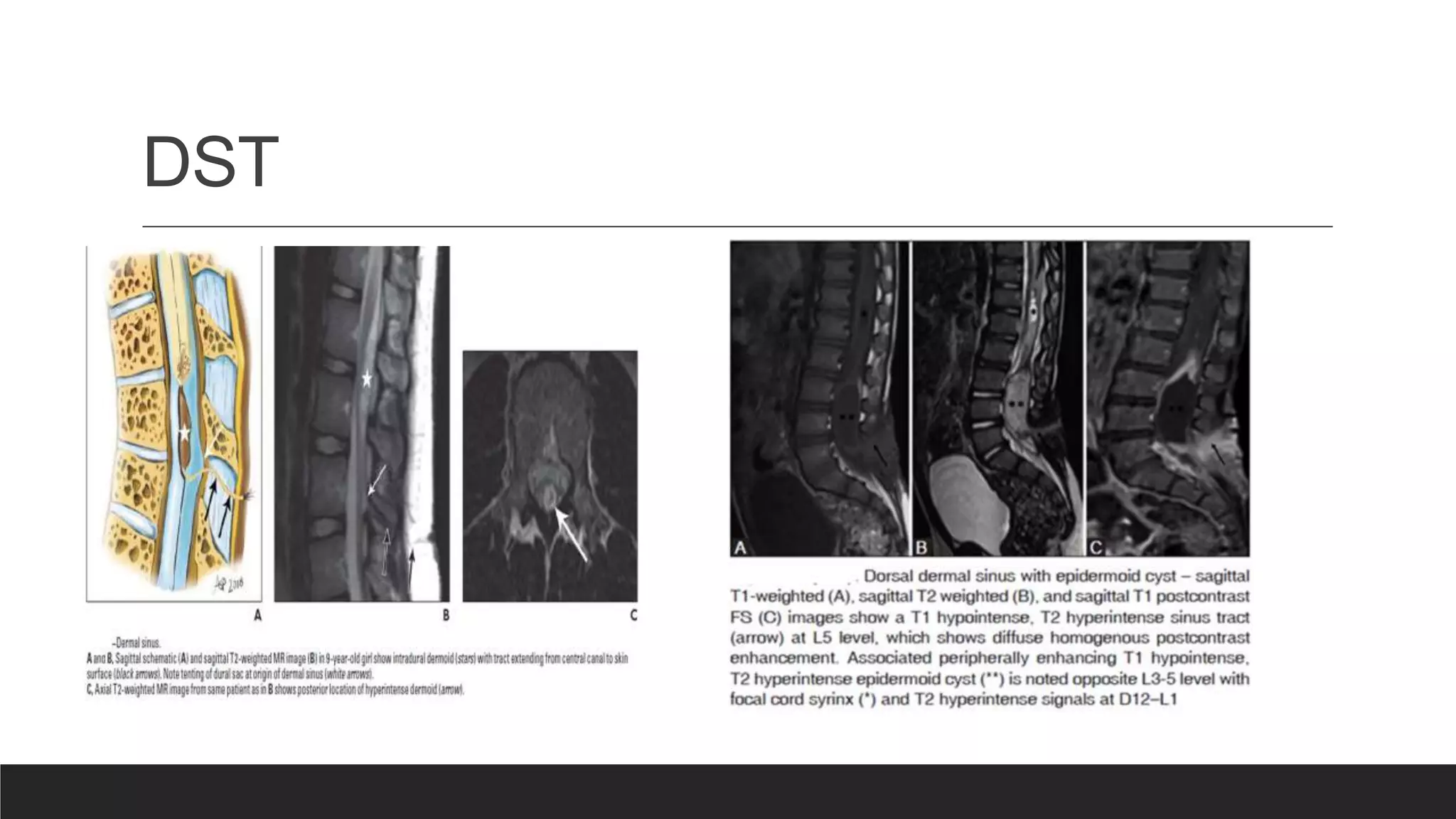 SPINAL dysraphism VP,,.pptx
