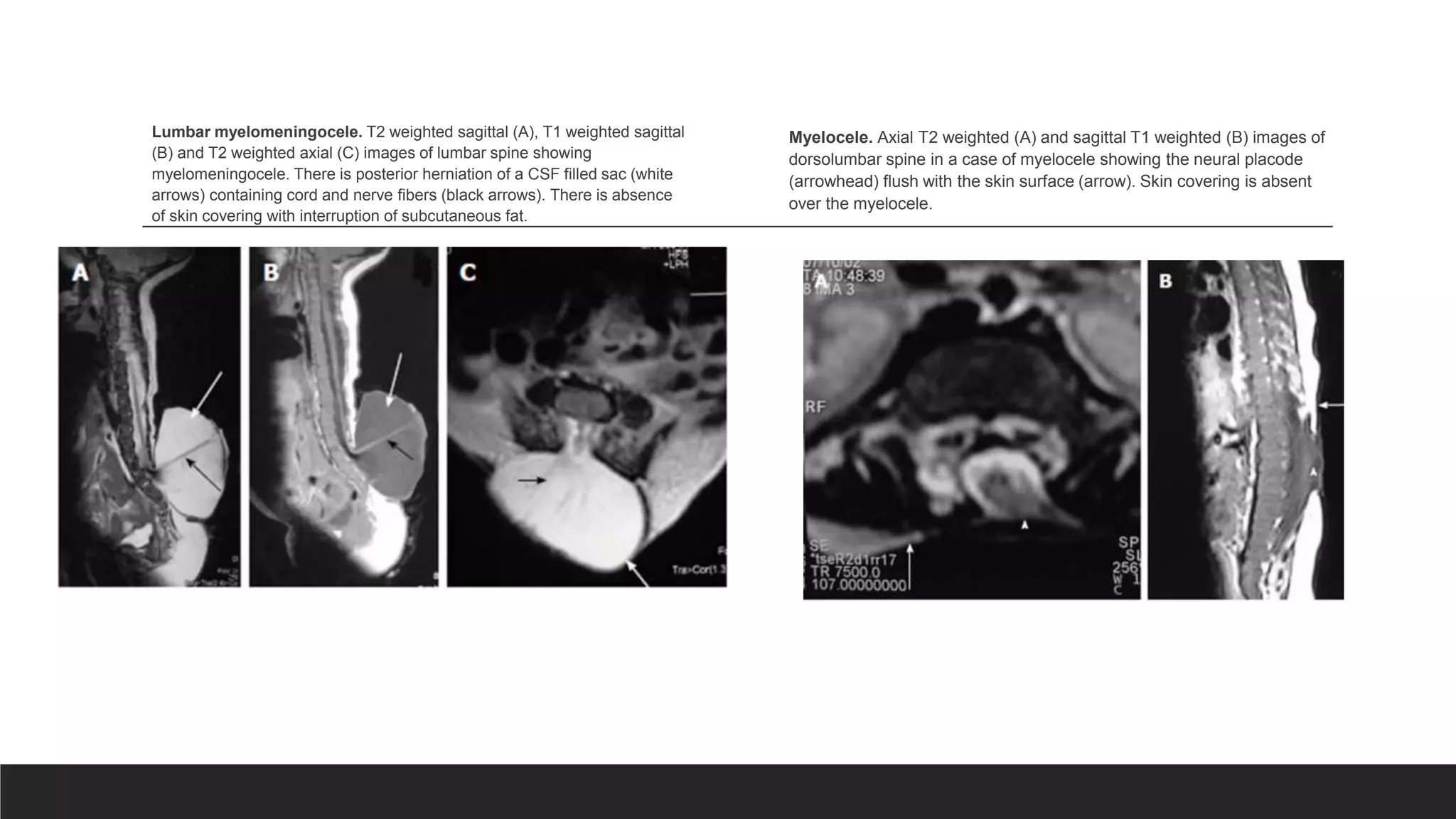 SPINAL dysraphism VP,,.pptx