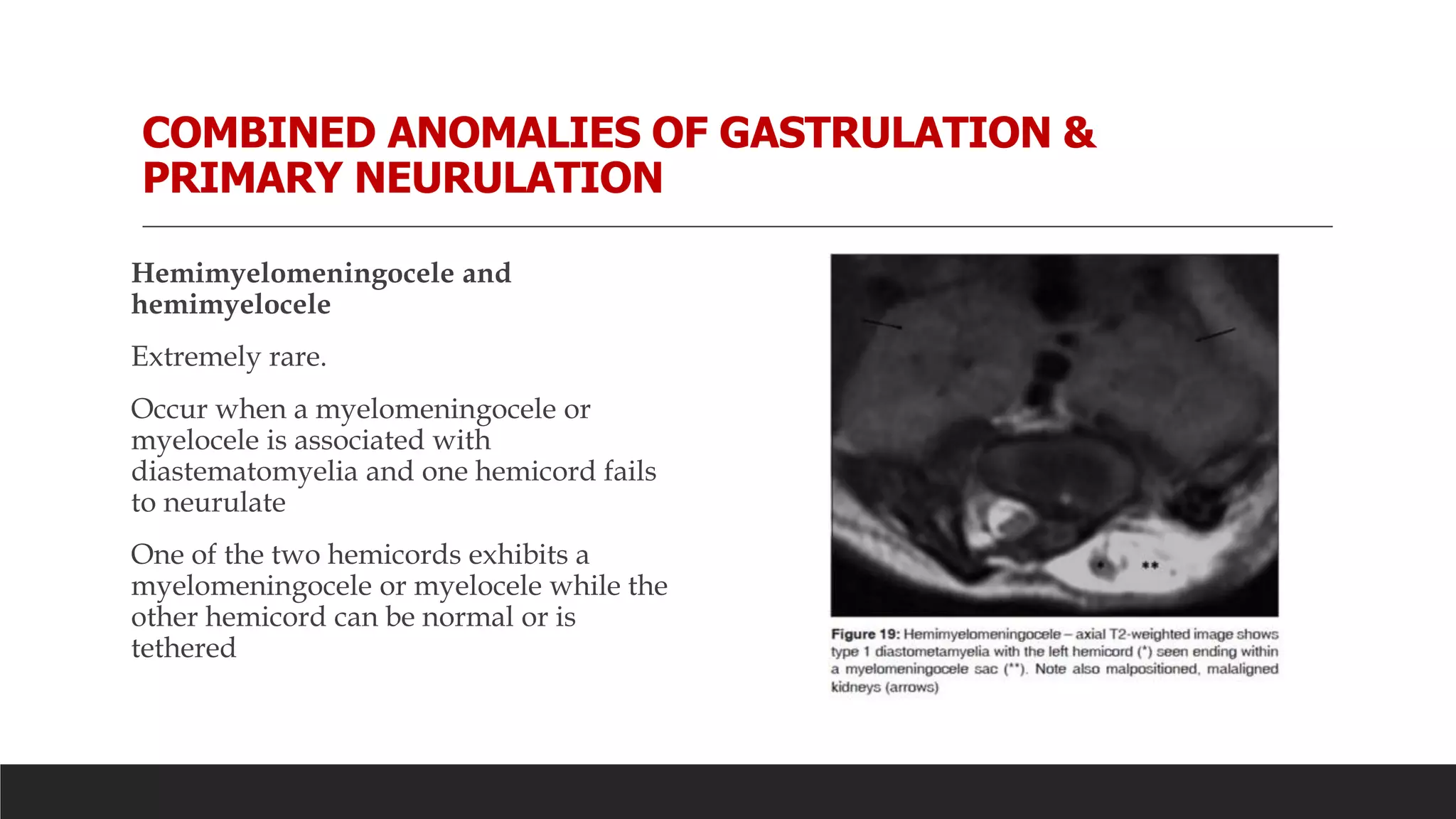 SPINAL dysraphism VP,,.pptx