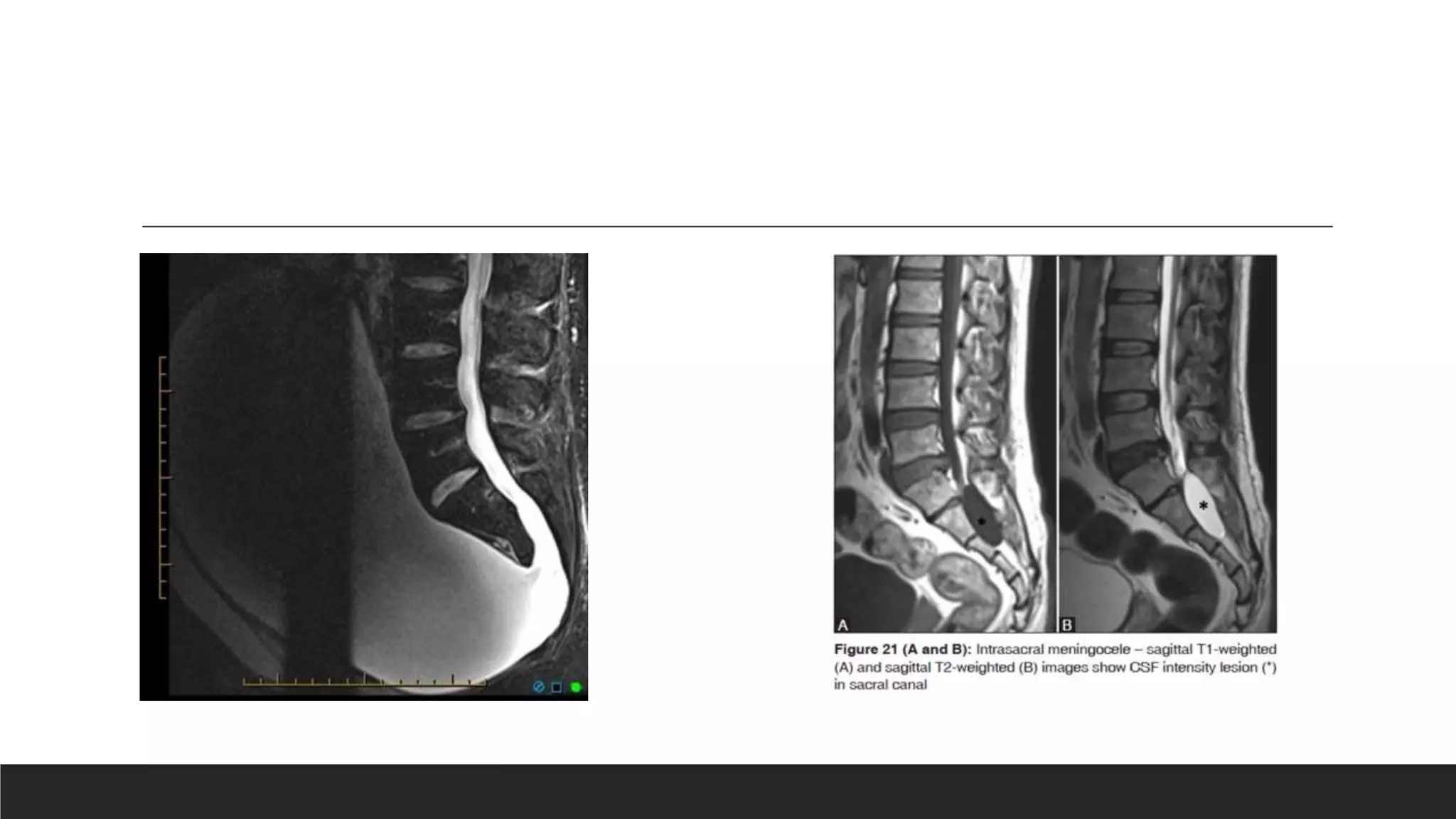 SPINAL dysraphism VP,,.pptx