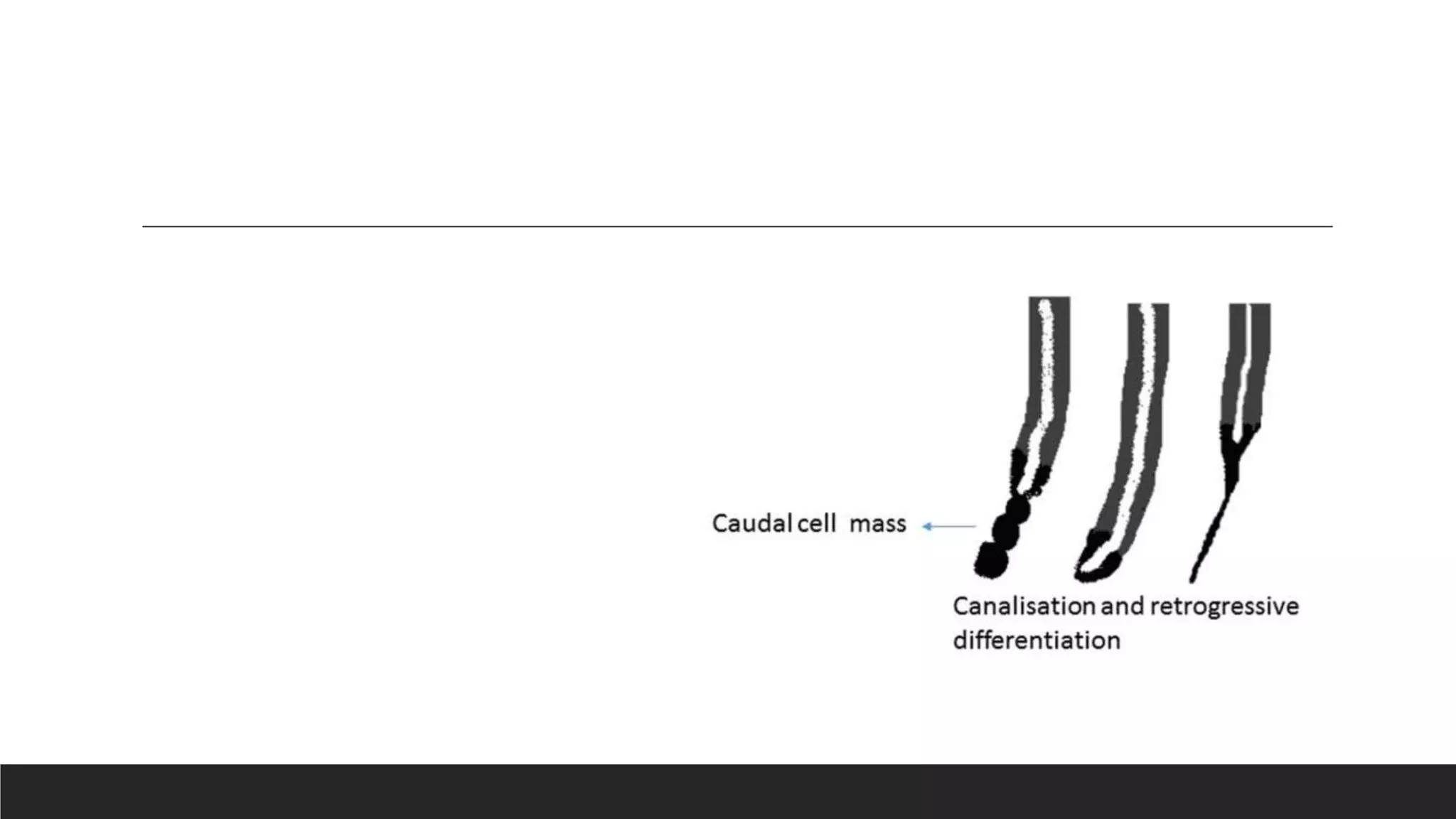 Spinal Dysraphism Vp Pptx