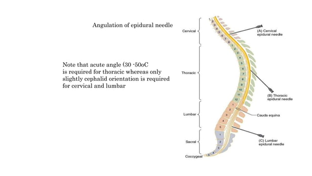 Neuraxial anaesthesia (Spinal, epdiural and caudal anesthesia) | PPTX ...