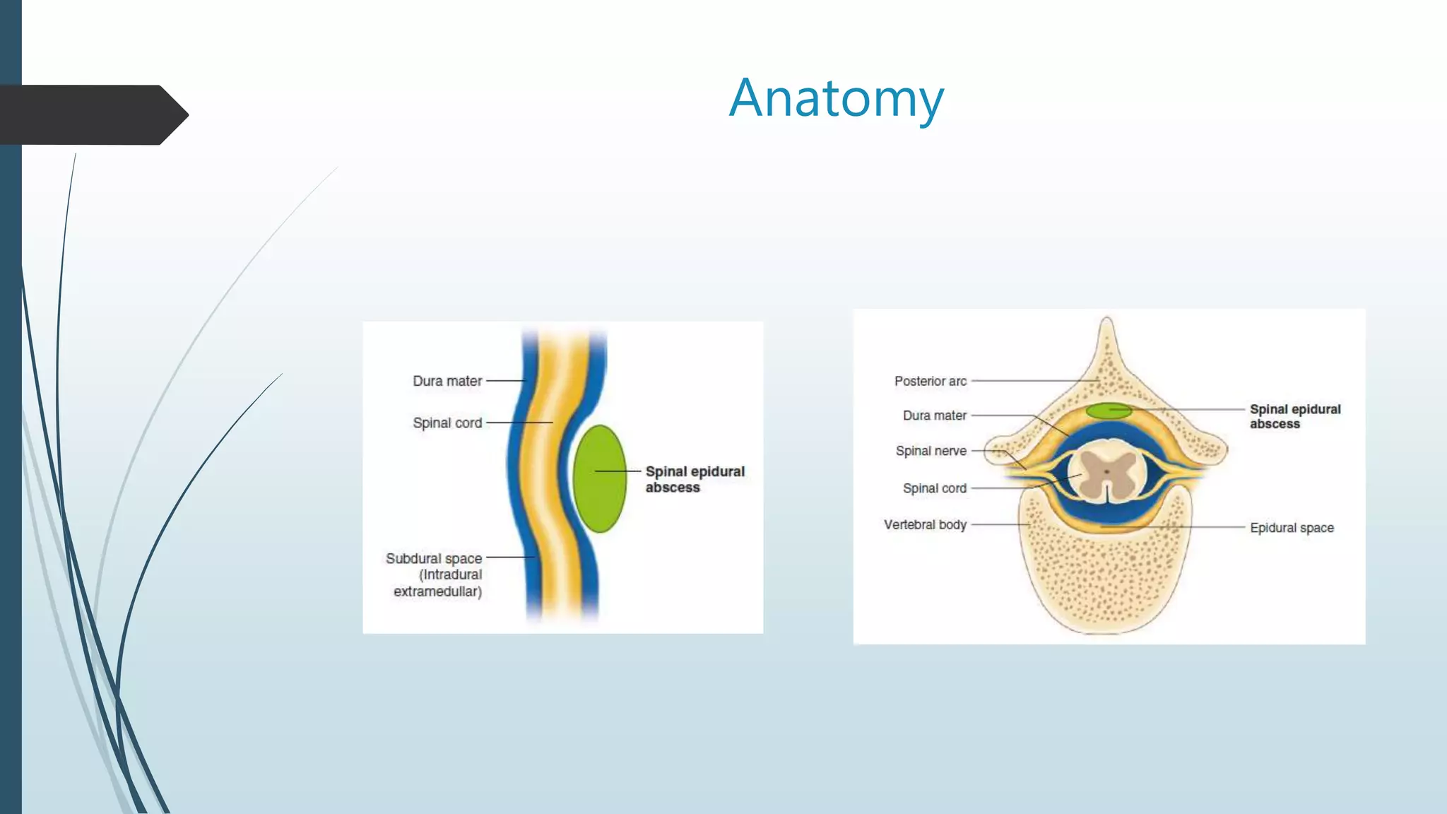 Spinal Epidural Abscess | PPTX