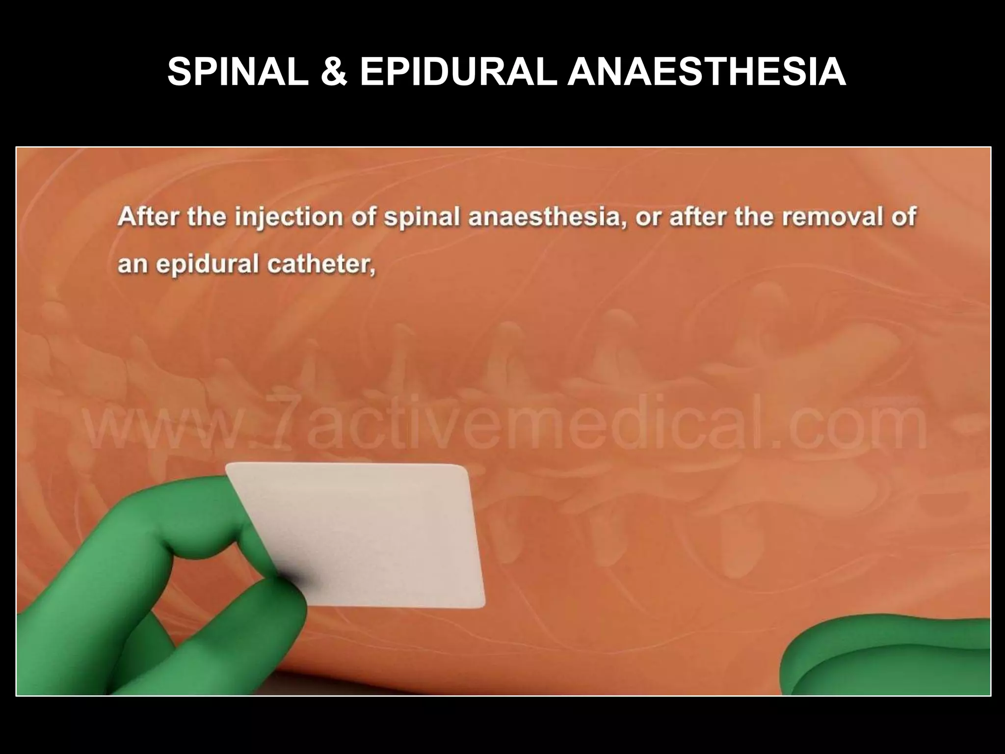Spinal & epidural anaesthesia | PPTX