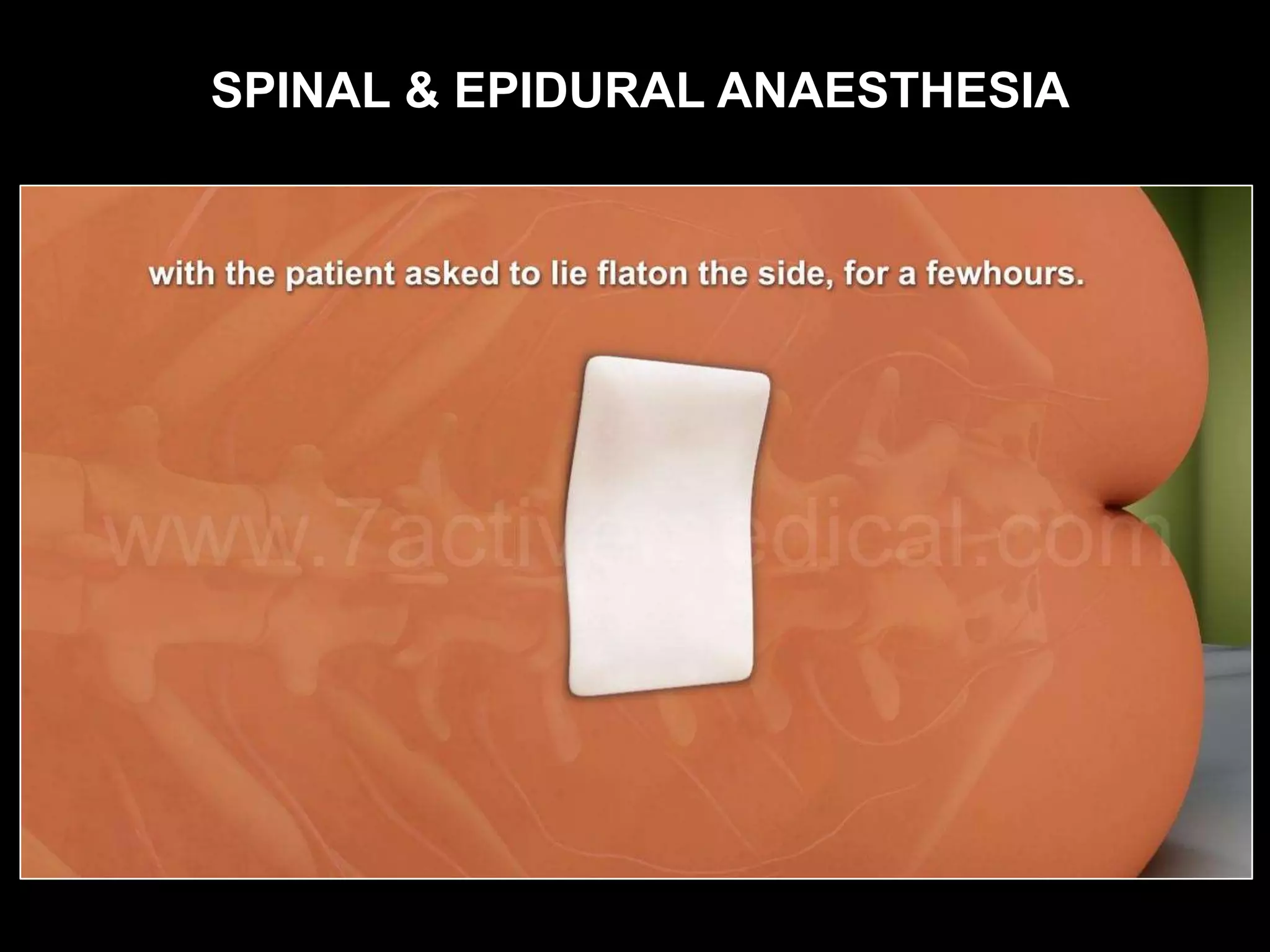 Spinal & epidural anaesthesia | PPTX