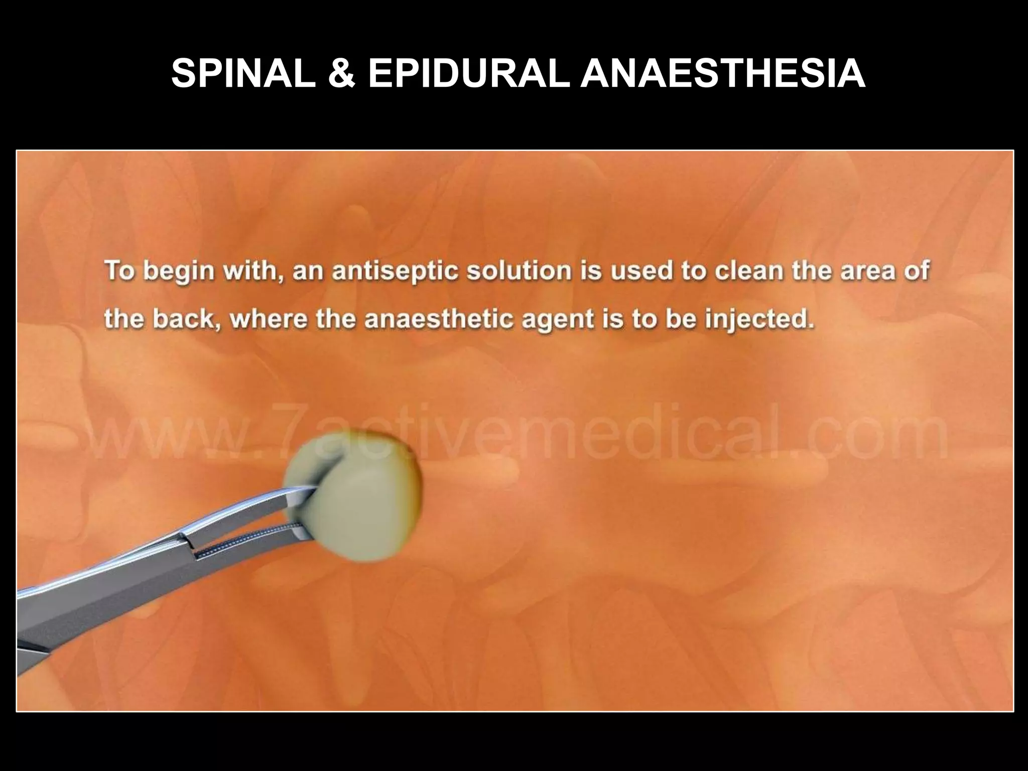 Spinal & epidural anaesthesia | PPTX
