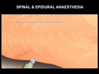 Spinal & epidural anaesthesia | PPTX