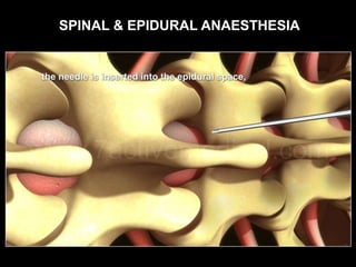 Spinal & epidural anaesthesia | PPTX