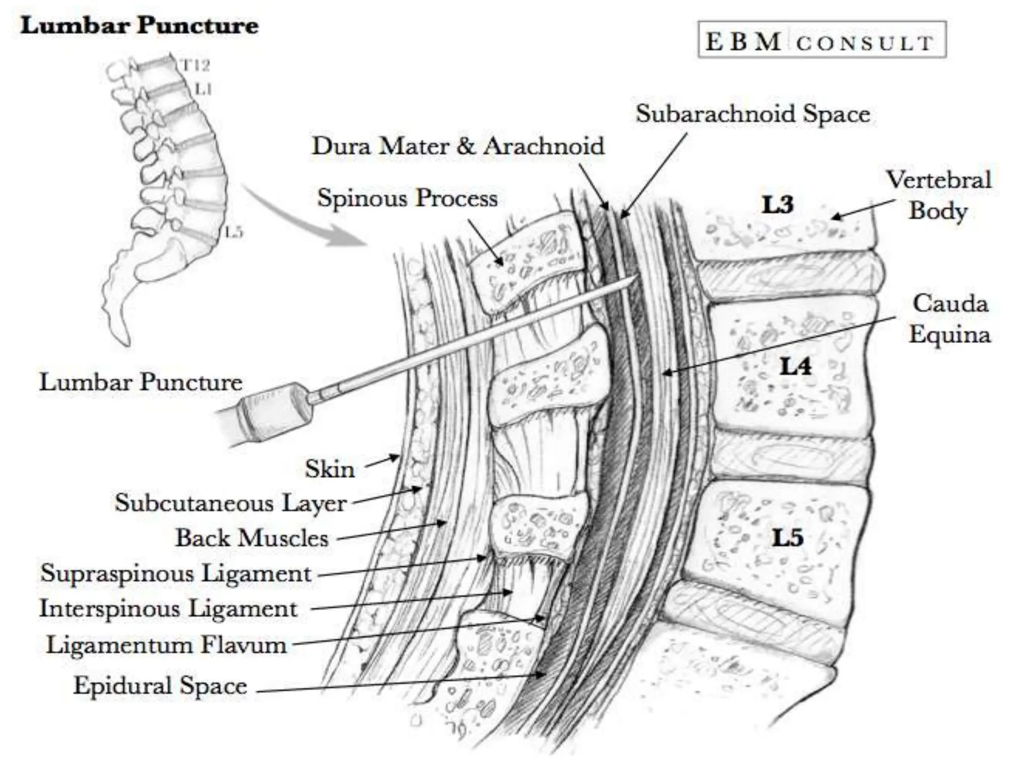 SPINAL & EPIDURAL ANAESTHESIA DR OYETUNDE.pptx