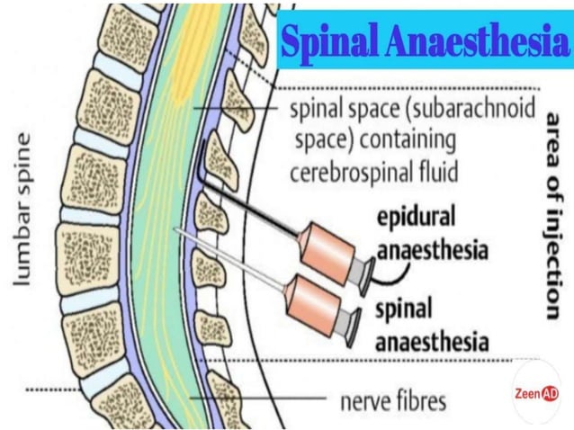 SPINAL & EPIDURAL ANAESTHESIA DR OYETUNDE.pptx