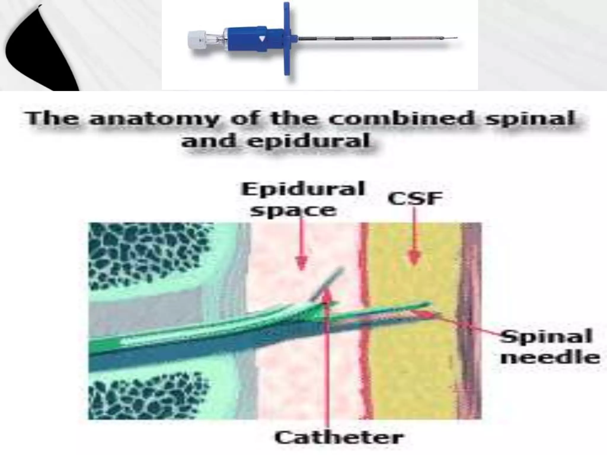 Aditi Panditrao's Spinal & epidural anaesthesia ug | PPTX