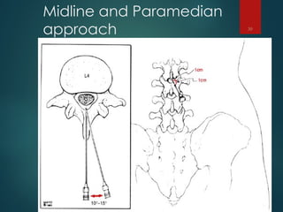 combined Spinal Epidural anaesthesia ppt | PPT