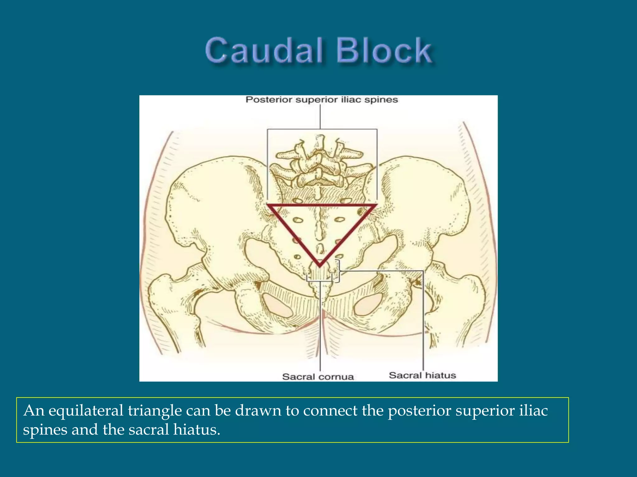 Spinal epidural | PPTX