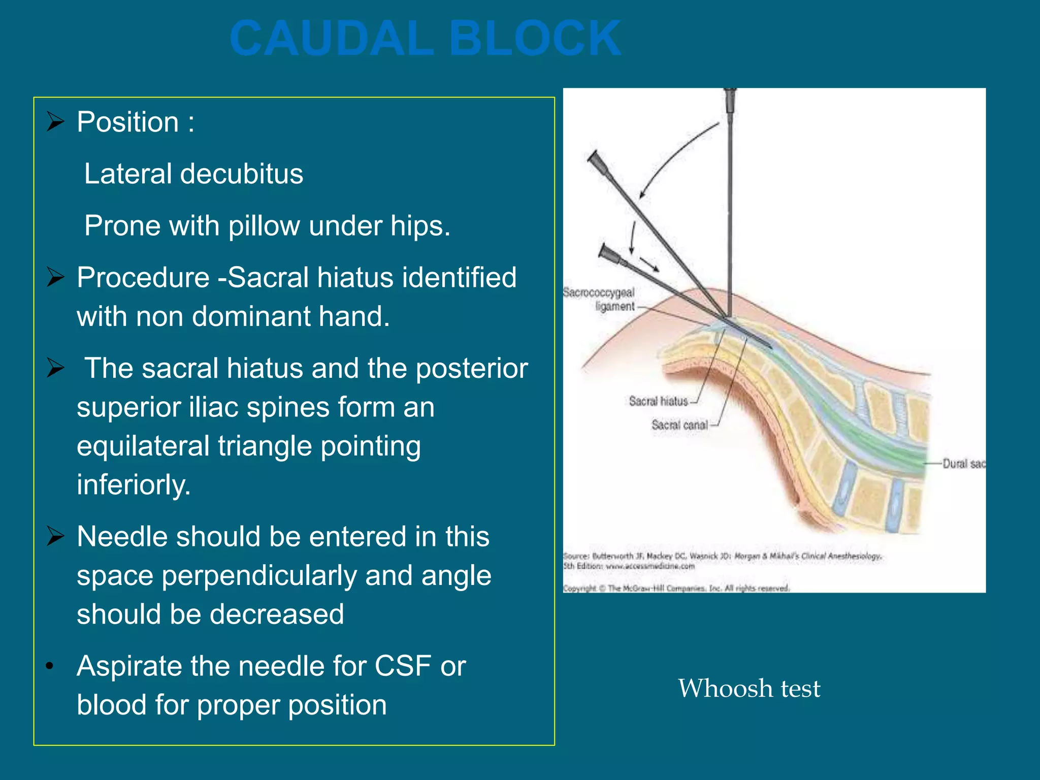 Spinal epidural | PPTX