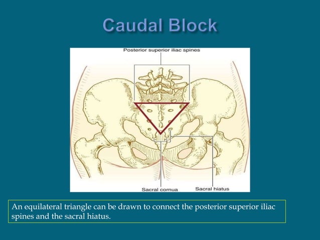 Spinal epidural | PPT