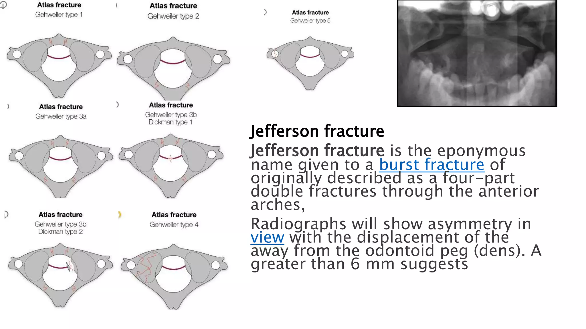 Spinal Fractures.pptx