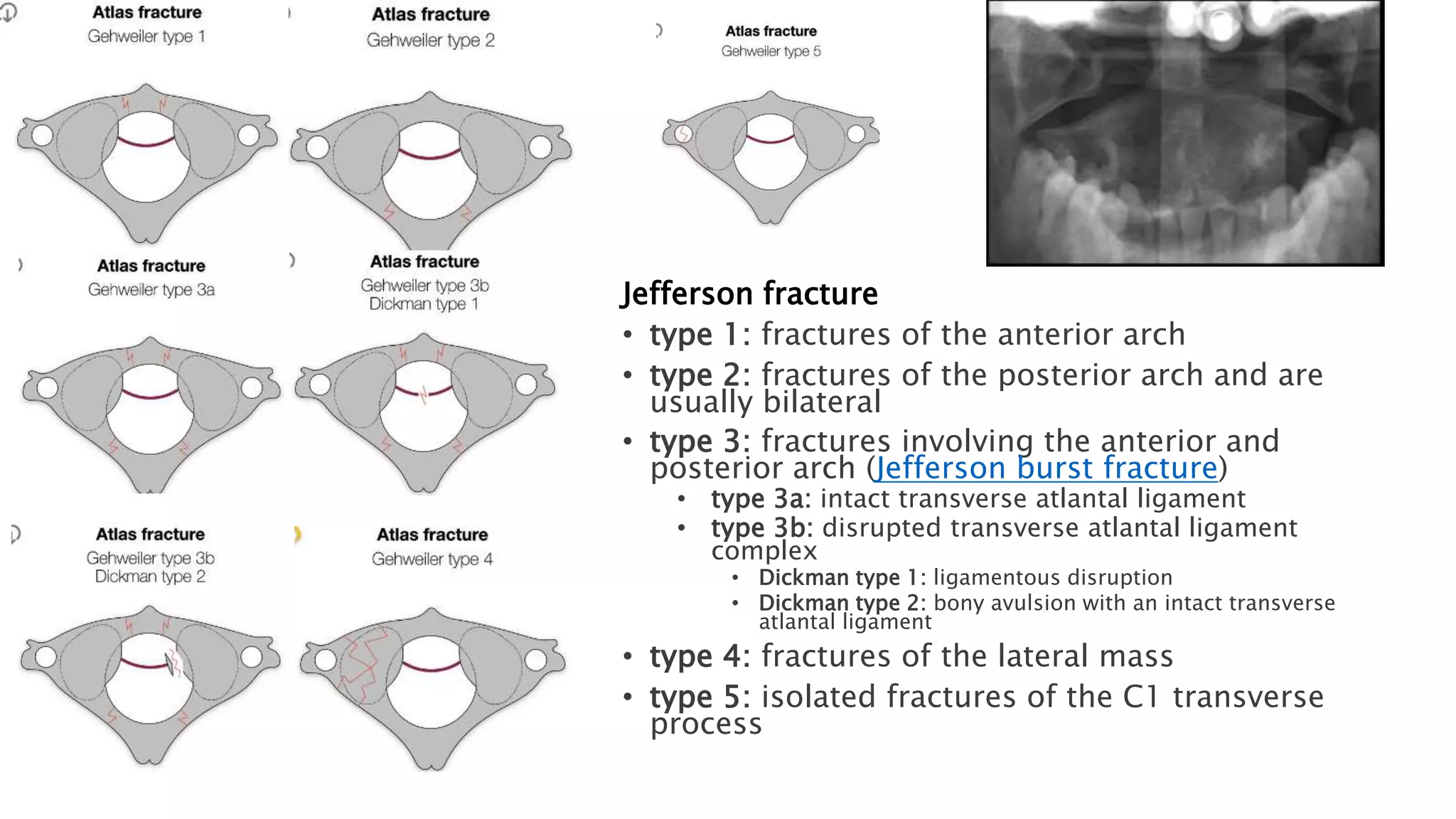Spinal Fractures.pptx