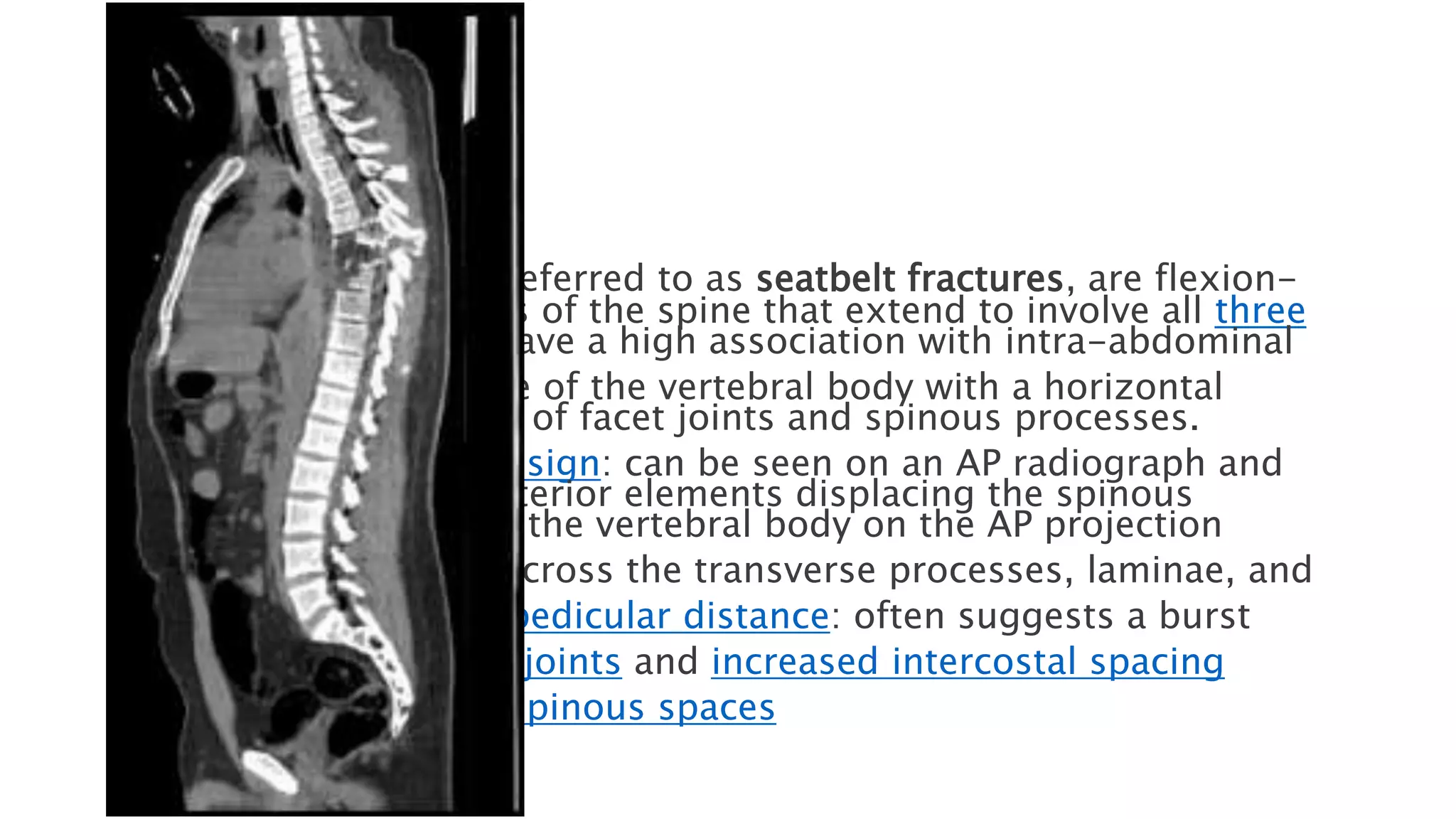 Spinal Fractures.pptx