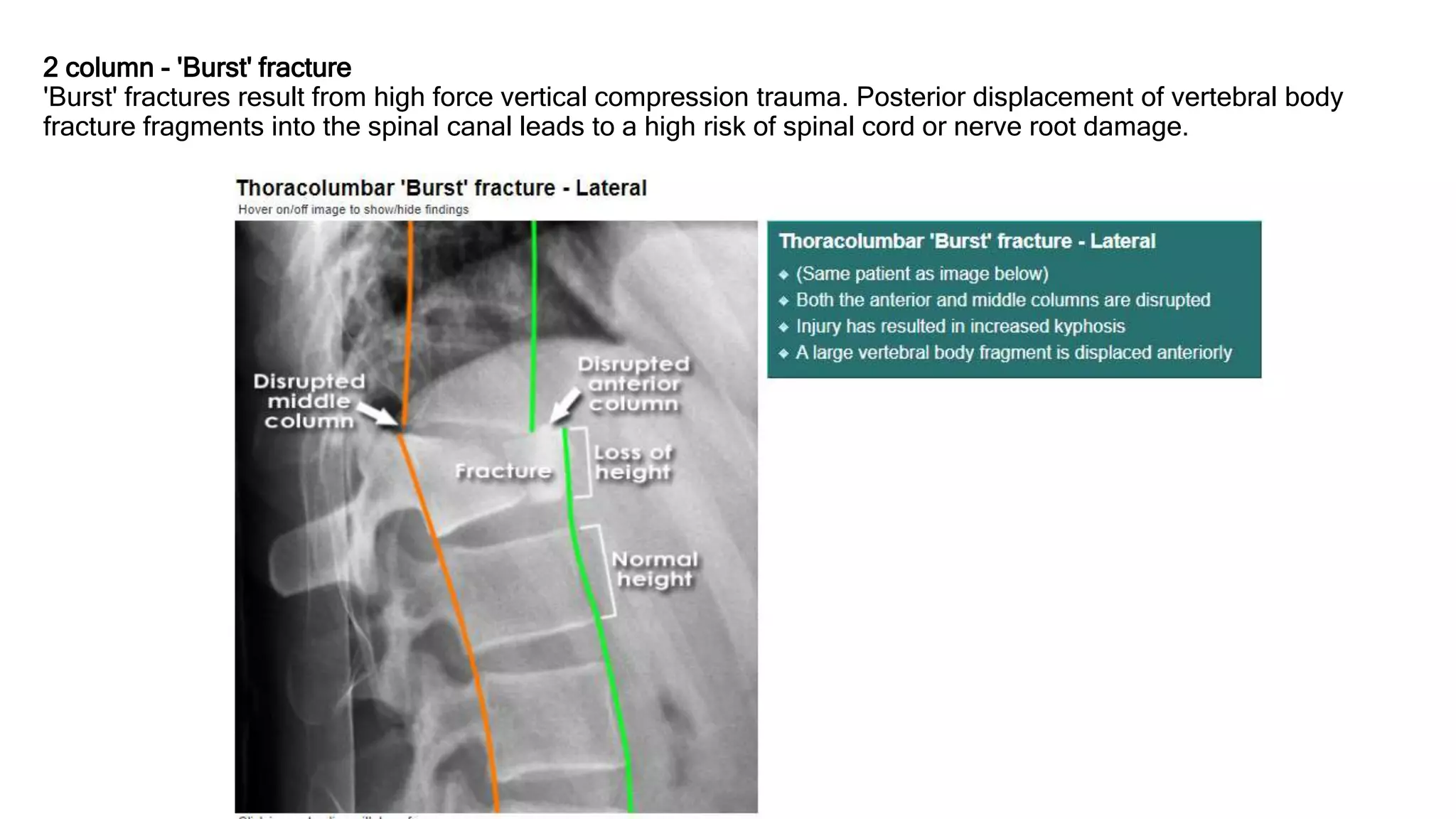 Spinal Fractures.pptx
