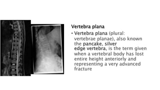Spinal Fractures.pptx