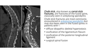 Spinal Fractures.pptx