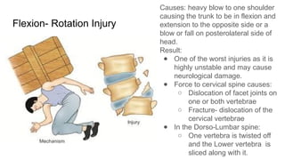 Spinal Fractures....................pptx | Death, Injury, or Military ...