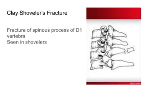 Spinal Fractures....................pptx
