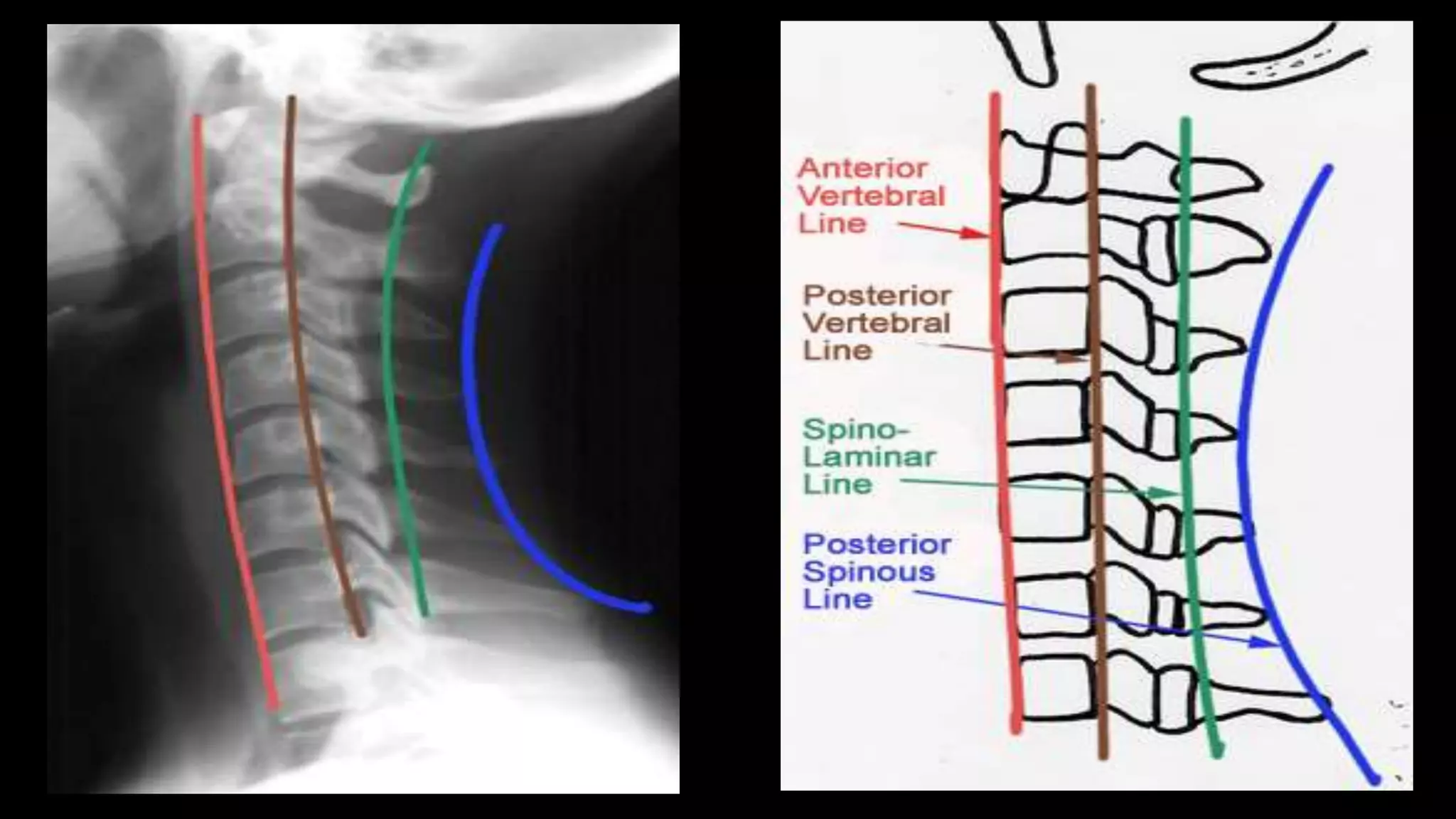 Spinal fractures classification - Core Surgical Trainees' teaching | PPTX