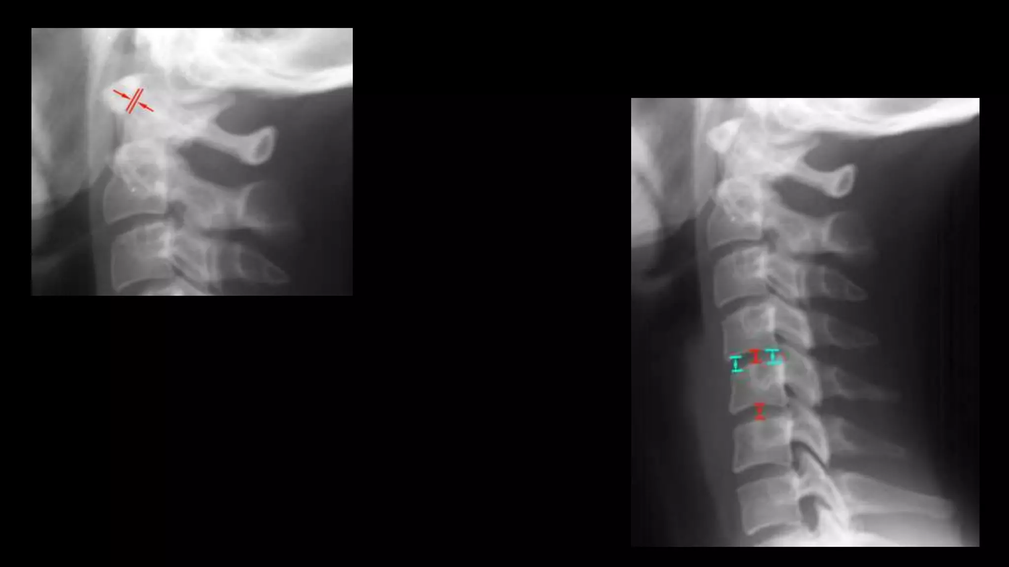 Spinal fractures classification - Core Surgical Trainees' teaching | PPTX