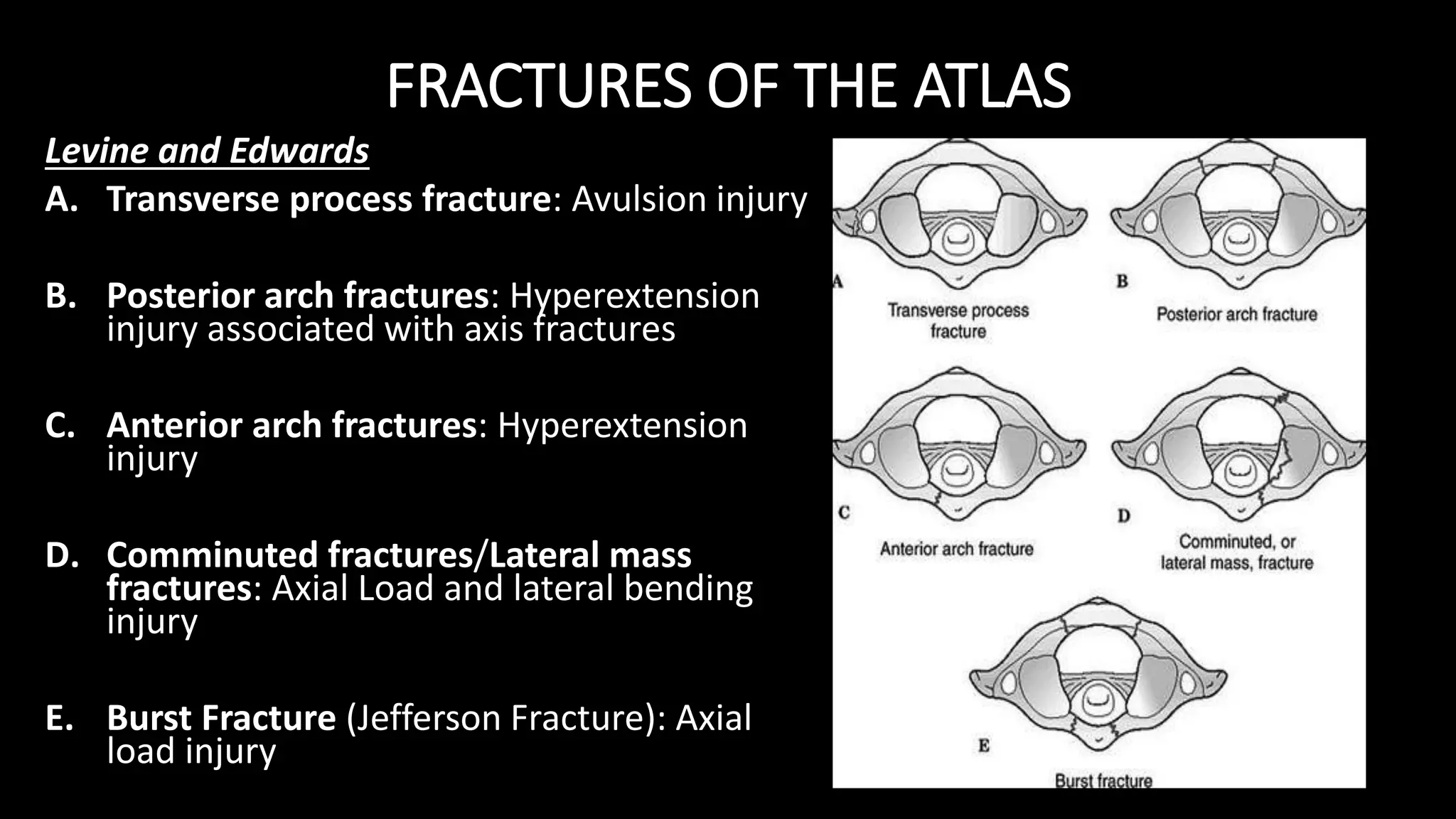 Spinal fractures classification - Core Surgical Trainees' teaching | PPTX