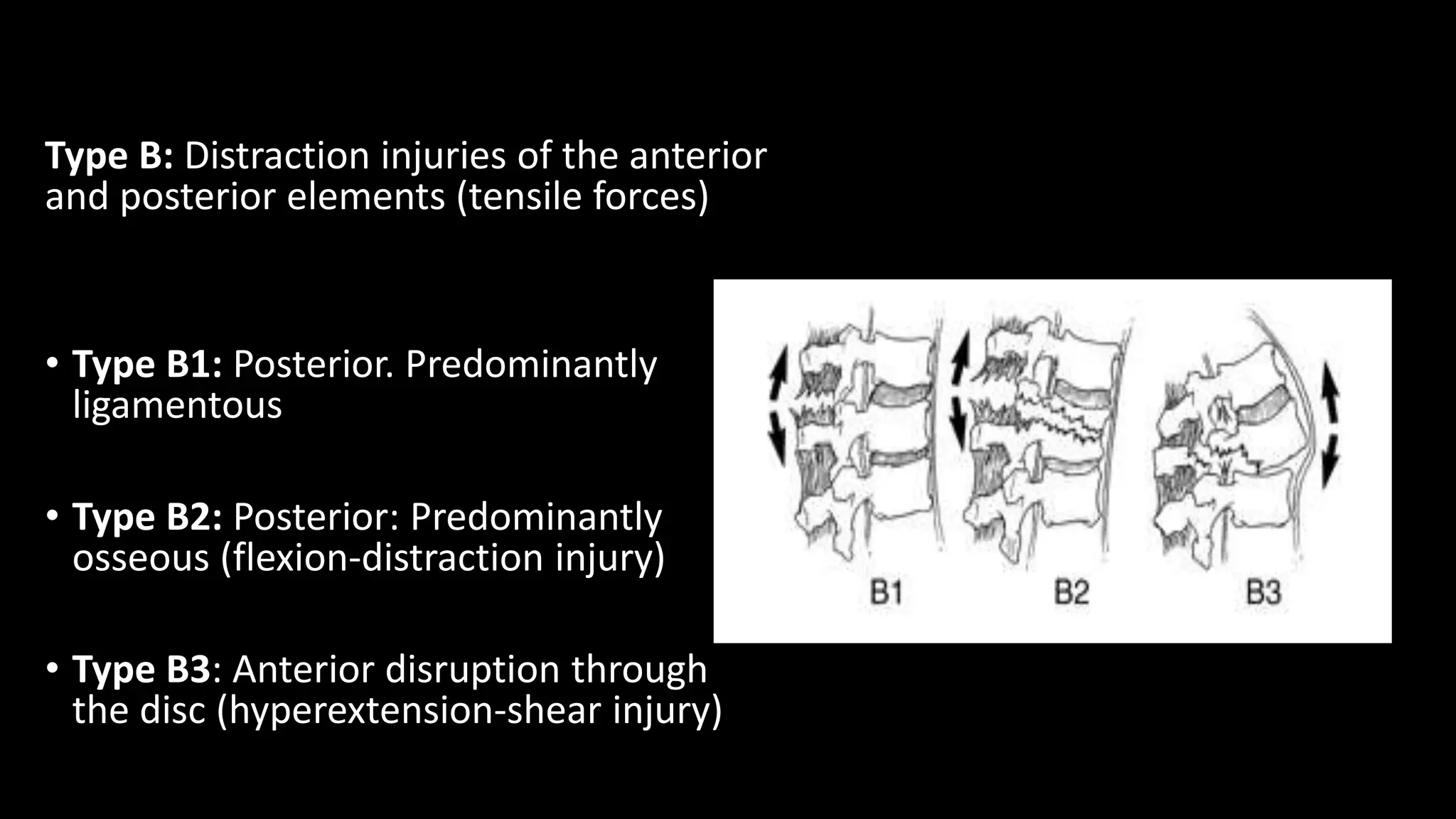 Spinal fractures classification - Core Surgical Trainees' teaching | PPTX