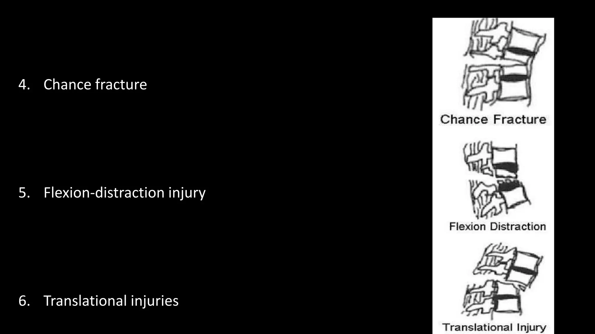 Spinal fractures classification - Core Surgical Trainees' teaching | PPTX