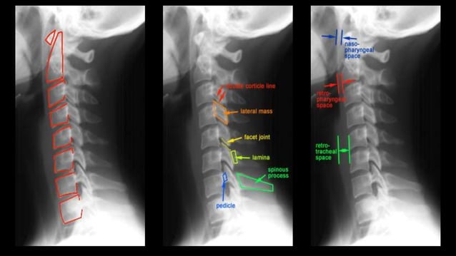 Spinal fractures classification - Core Surgical Trainees' teaching | PPTX