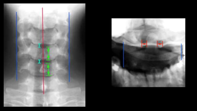 Spinal fractures classification - Core Surgical Trainees' teaching | PPTX