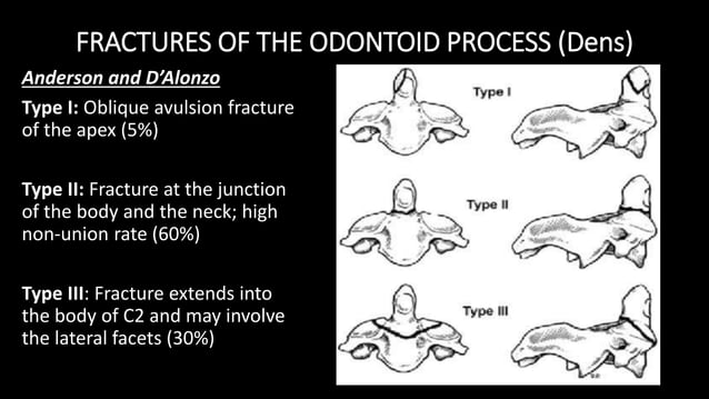 Spinal fractures classification - Core Surgical Trainees' teaching | PPTX