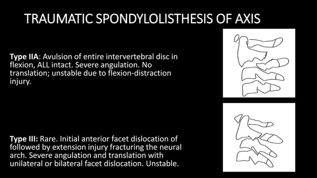 Spinal fractures classification - Core Surgical Trainees' teaching | PPTX