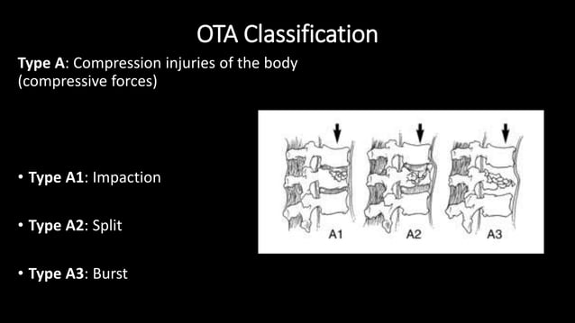 Spinal fractures classification - Core Surgical Trainees' teaching | PPTX
